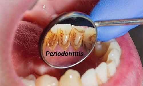 Lasers Improve Outcomes in Periodontal Flap Microsurgery, reports research