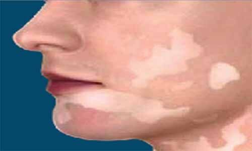 Ruxolitinib cream associated with higher repigmentation of vitiligo ...