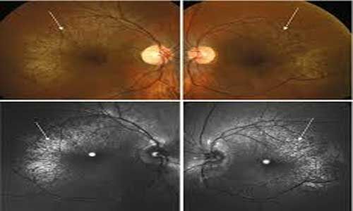 Advancement made in Gene Therapy for x-Linked Retinitis Pigmentosa