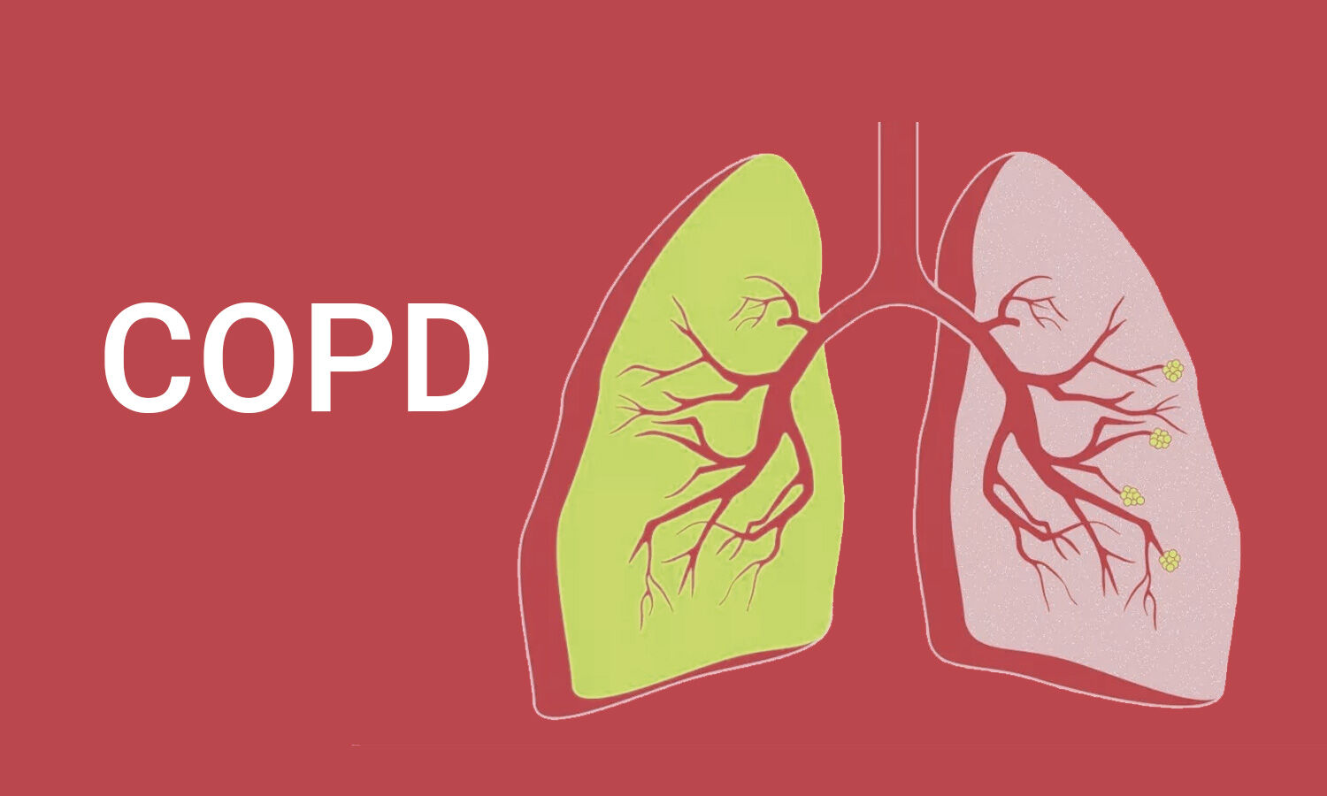 Non invasive Ventilation In Chronic Stable Hypercapnic COPD ATS Guidelines 