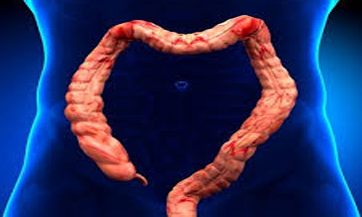 Recommendations for Treatment of Ulcerative Colitis: AGA Guidelines