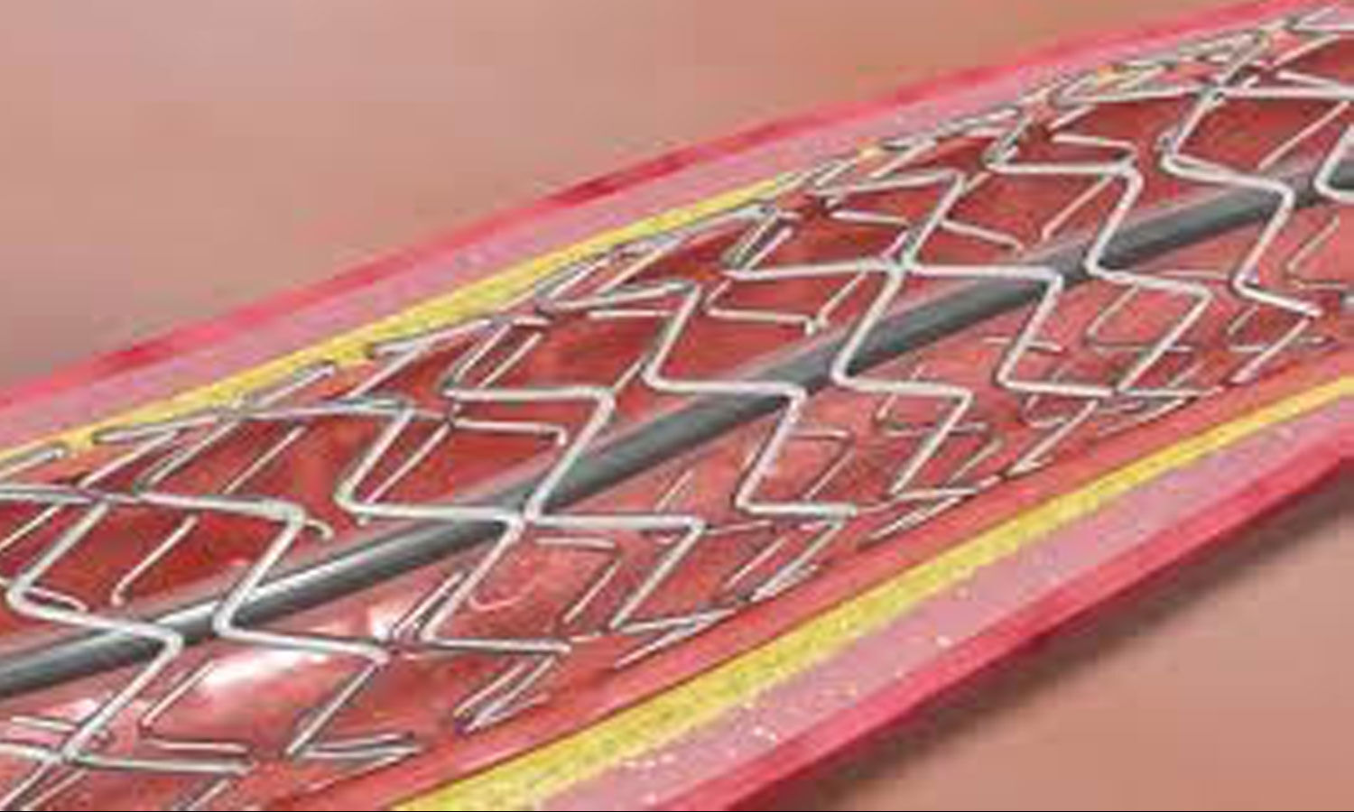 Polymer based stent with short DAPT effective in high risk patients