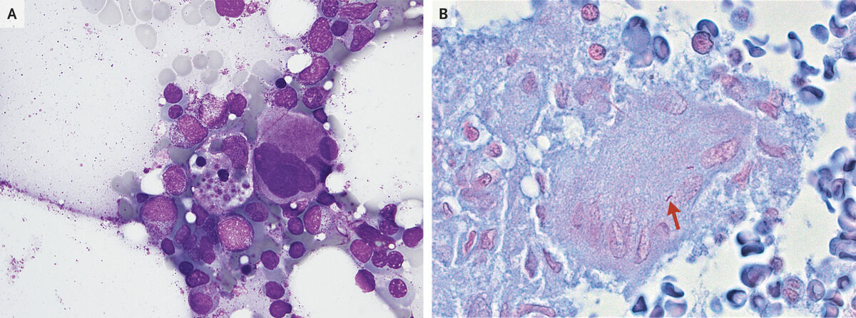 Case of HLH with disseminated tuberculosis reported in NEJM