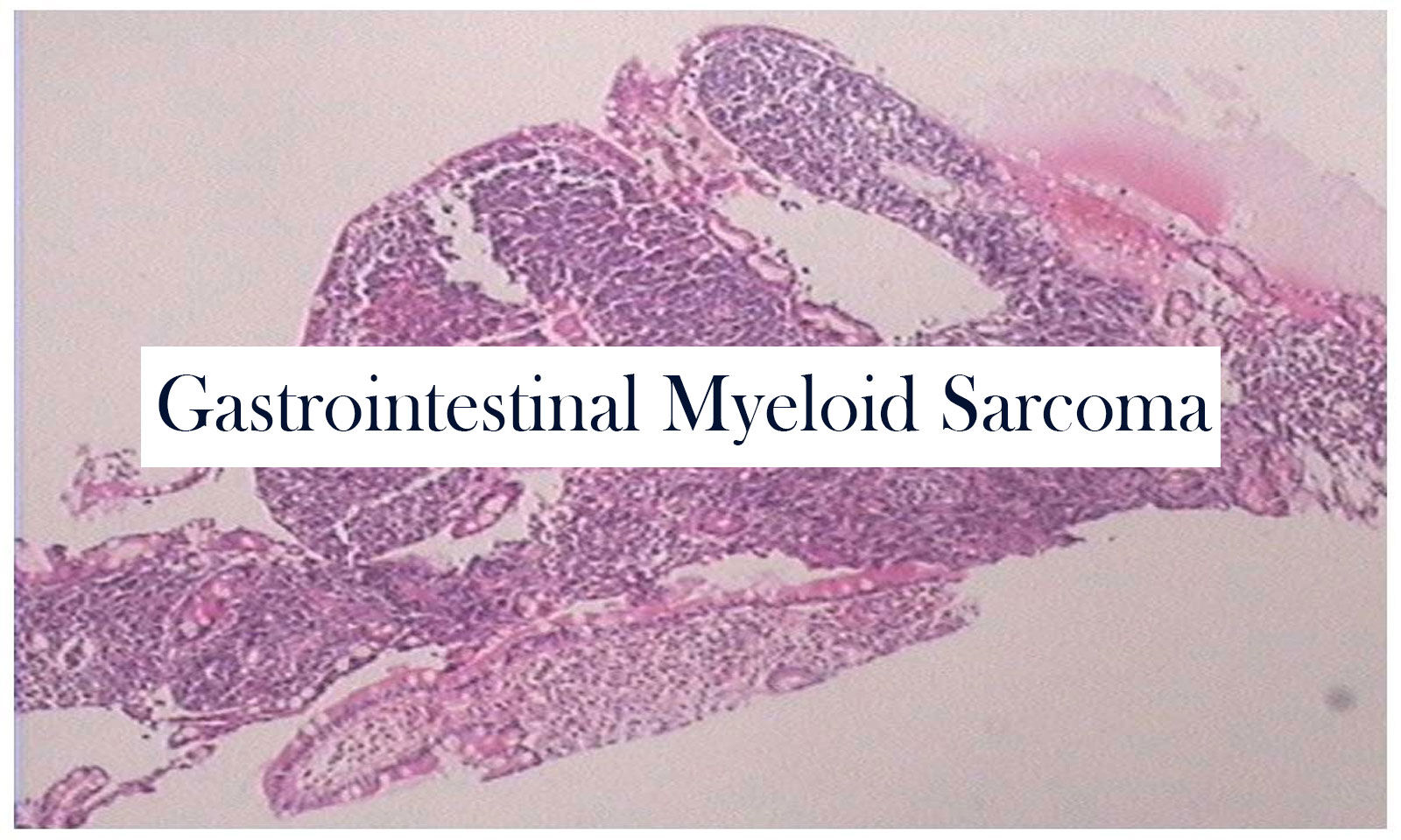 Rare case of Gastrointestinal Myeloid Sarcoma reported in NEJM