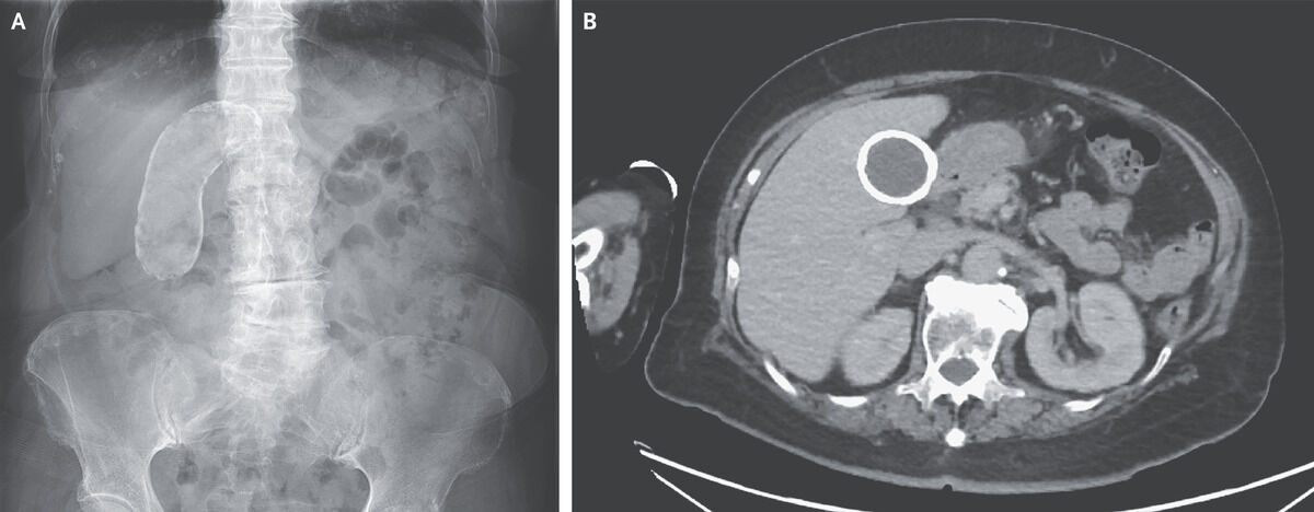 Rare Case of calcified gallbladder reported in NEJM