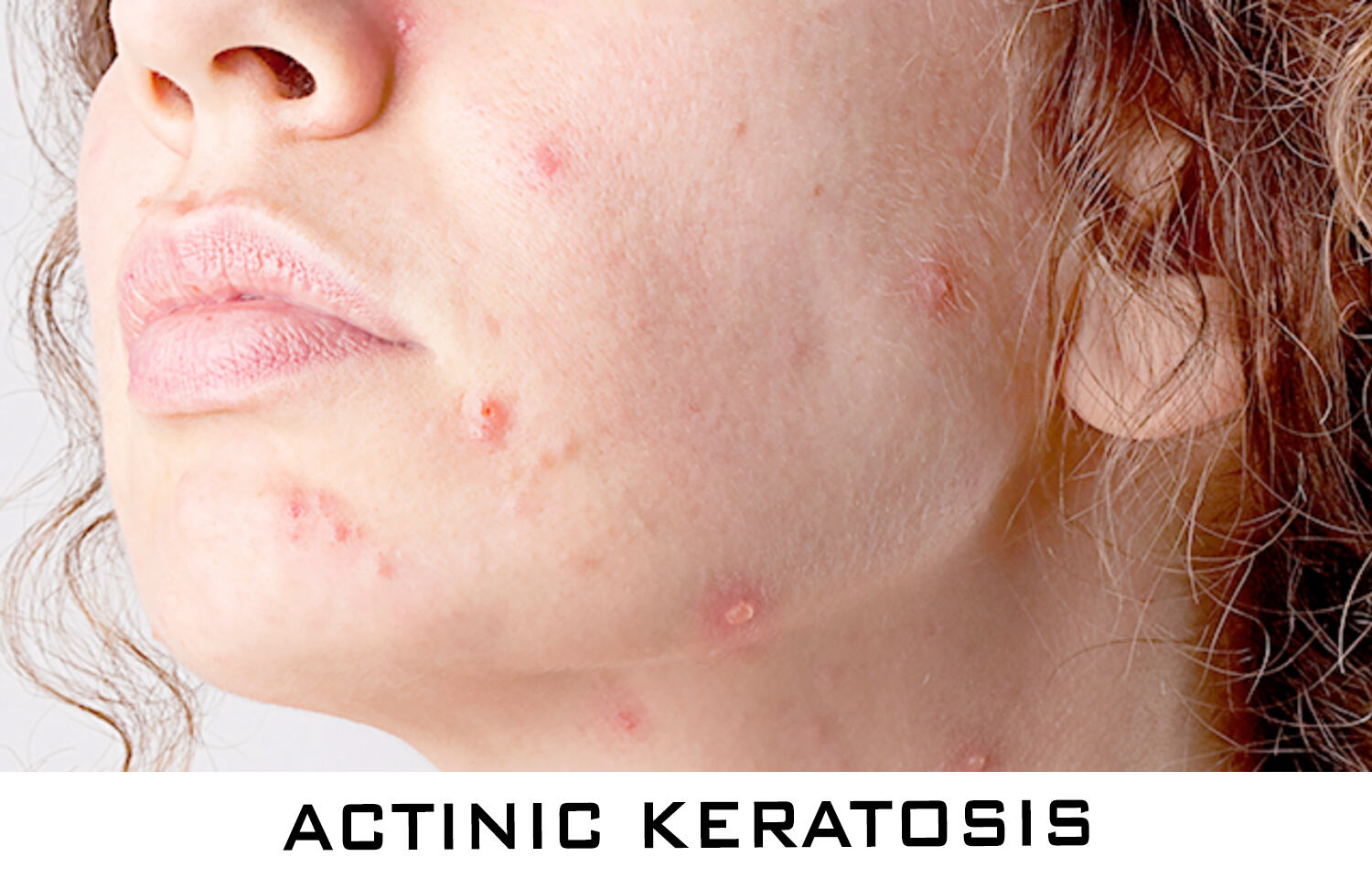 FDA Approves Topical Treatment for Actinic Keratosis