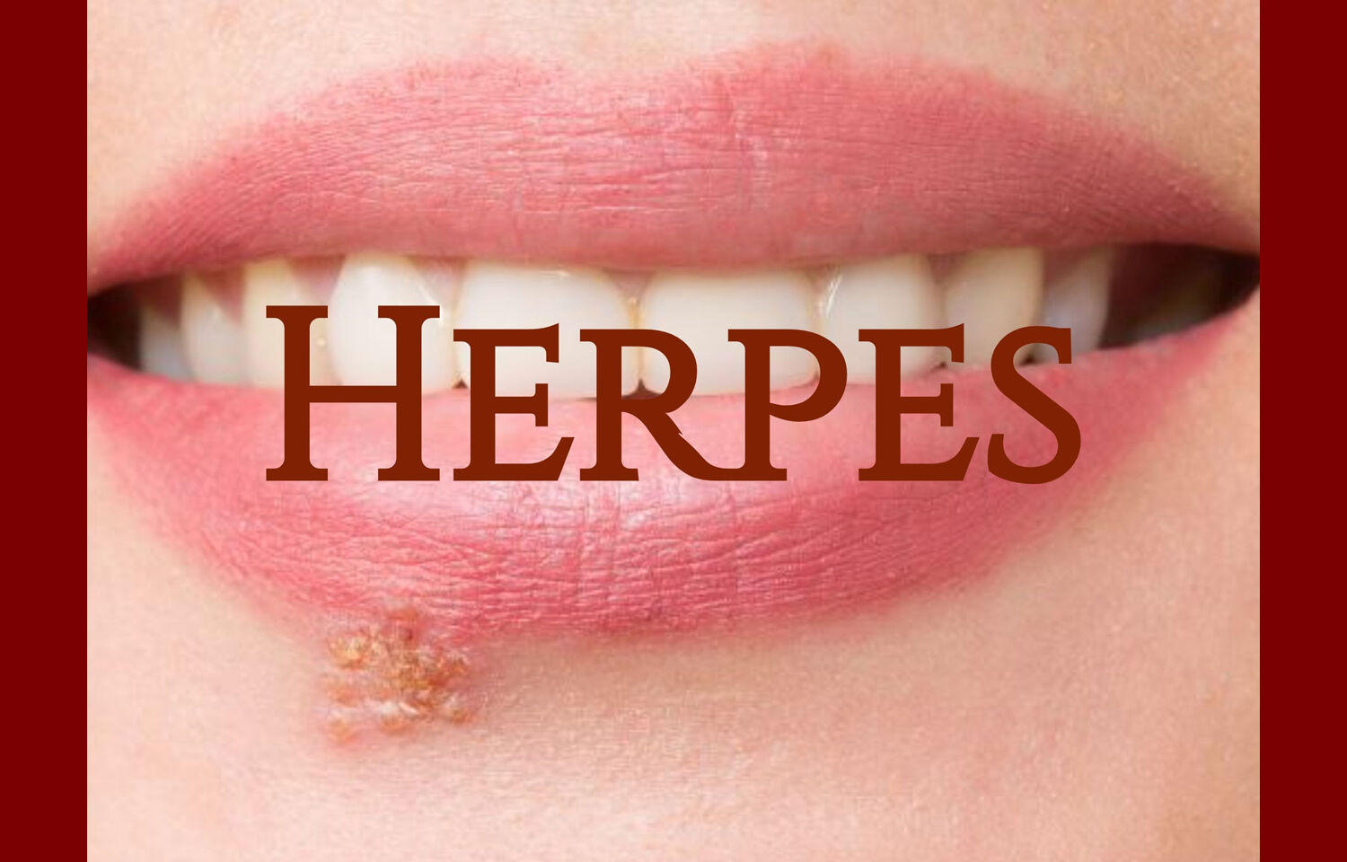 Drug for rare disorder shows promise for treating herpes viruses