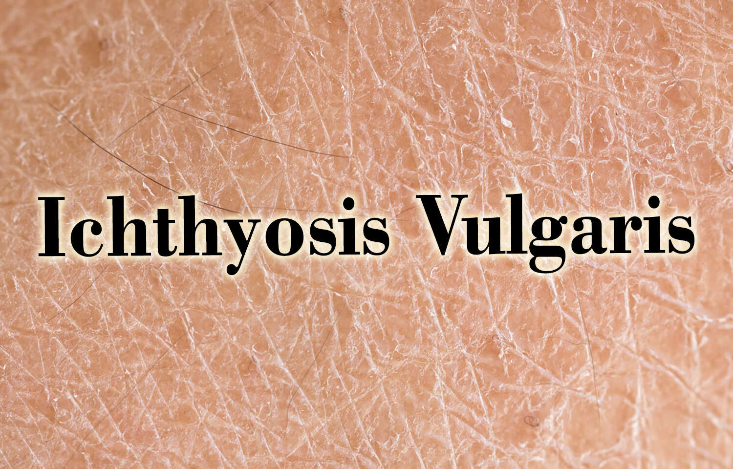 Ichthyosis Scoring System powerful tool to measure global ichthyosis ...