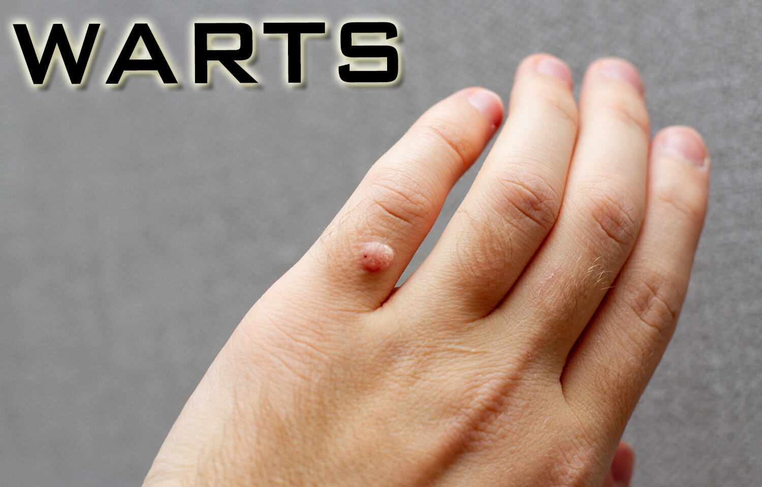 Tazarotene and Imiquimod Offer Similar Efficacy in Treating Plane Warts ...