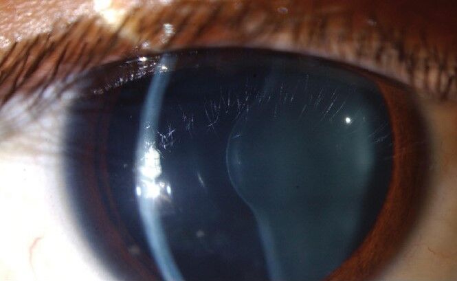 Alport syndrome presenting as Bilateral spontaneous anterior lens ...