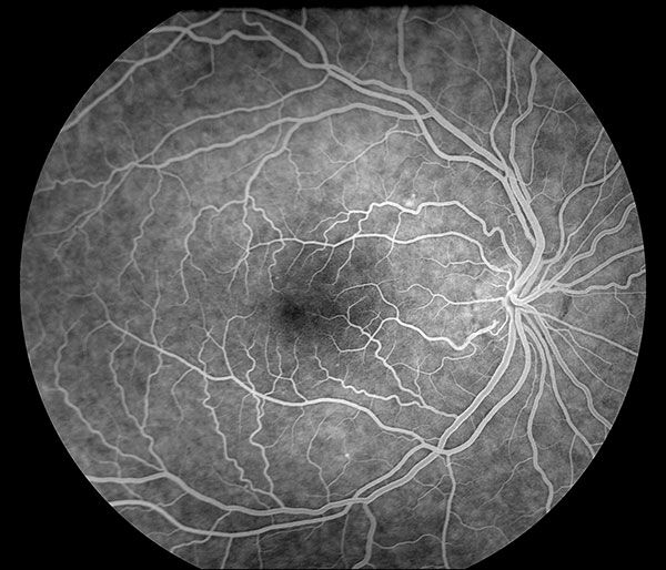 Retinal Vasospasm Similar to Raynaud's Phenomenon in a Patient of SLE ...