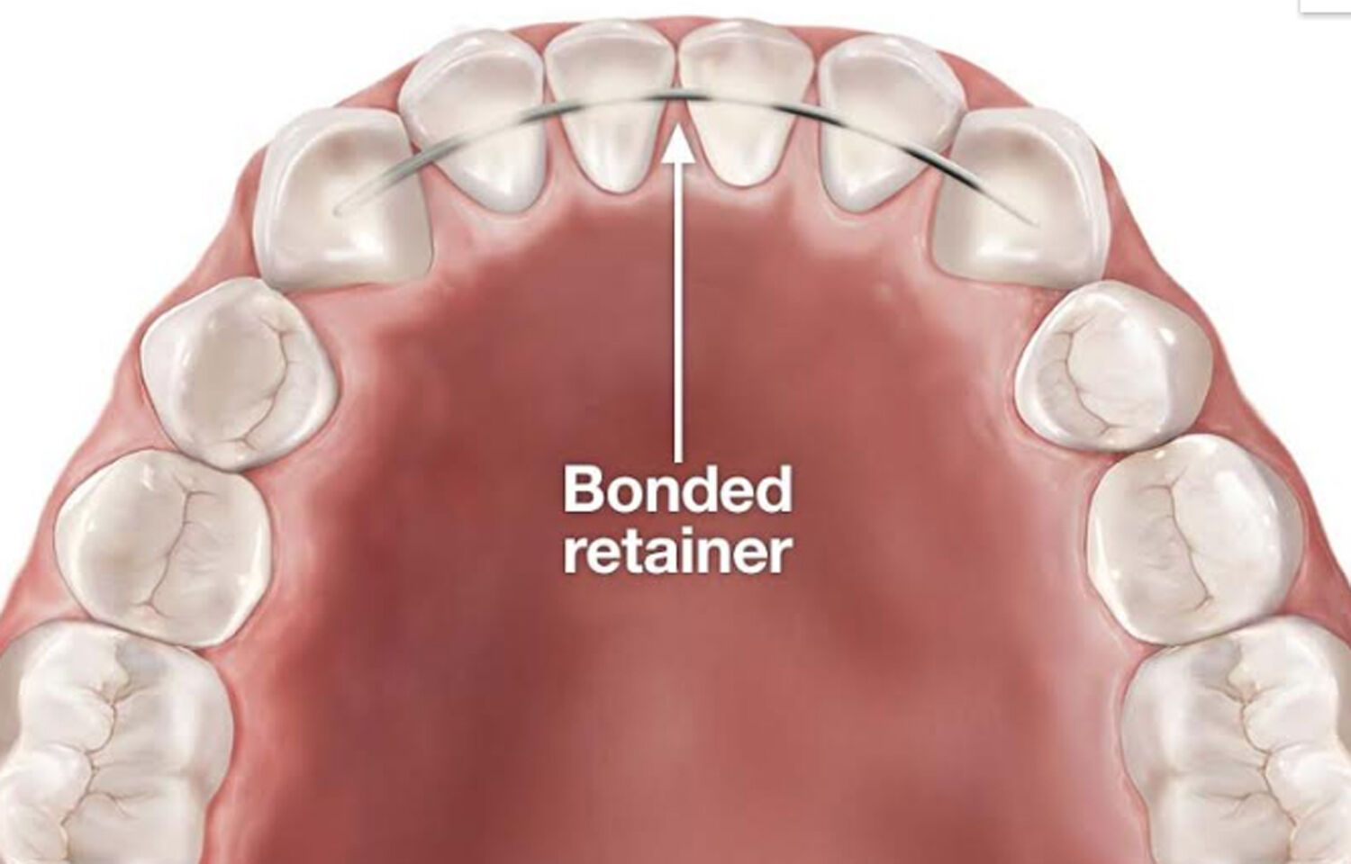 Challenging task- Unwanted tooth movements in-spite of orthodontic ...