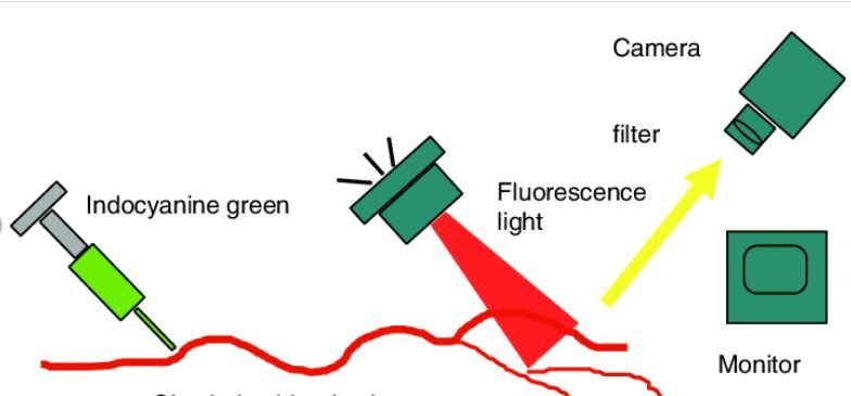Fluorescence angiography may help identify leaks after colorectal ...