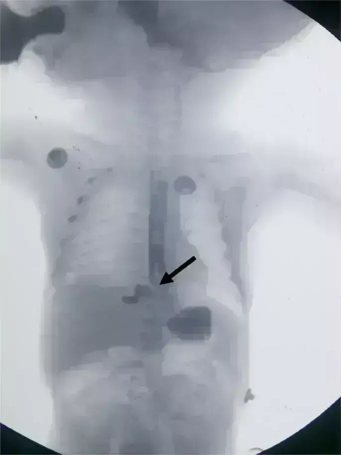 Rare case of neonatal Idiopathic esophageal perforation reported