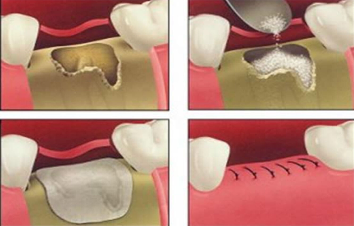 Ridge preservation may reduce ridge resorption in sockets of ...