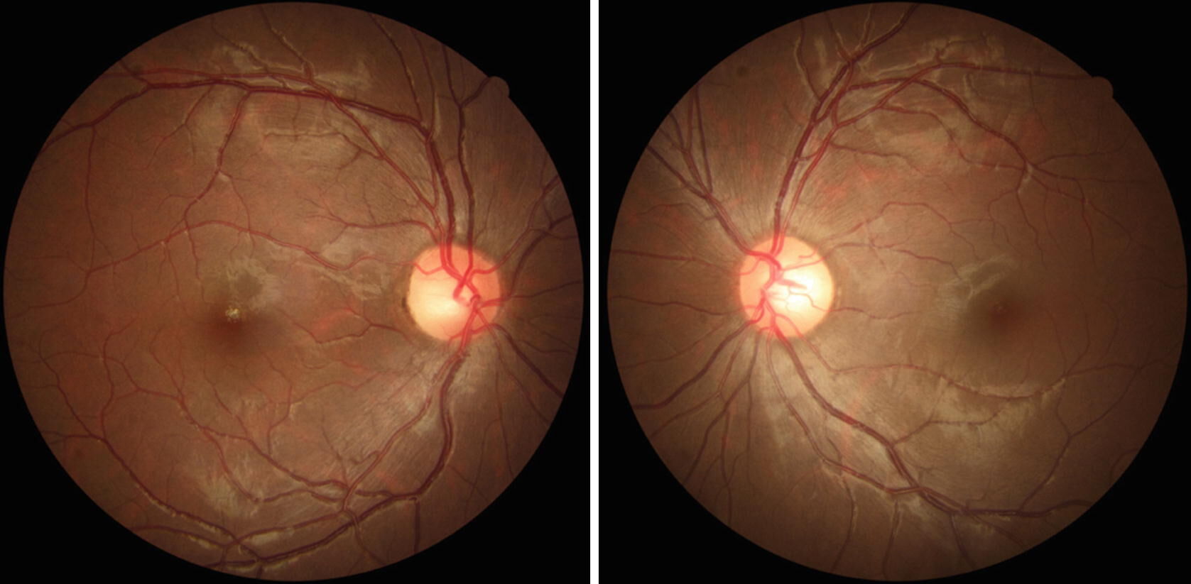 Experimental therapy of One Eye may Improve vision in other in ...