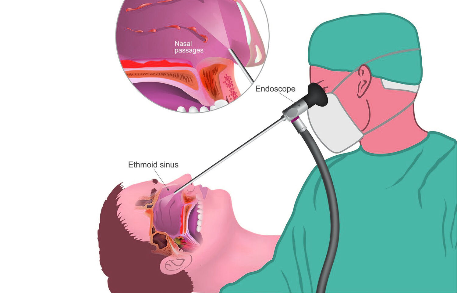 Cost-effective nasolaryngoscopy hood helps reduce COVID-19 exposure in ...