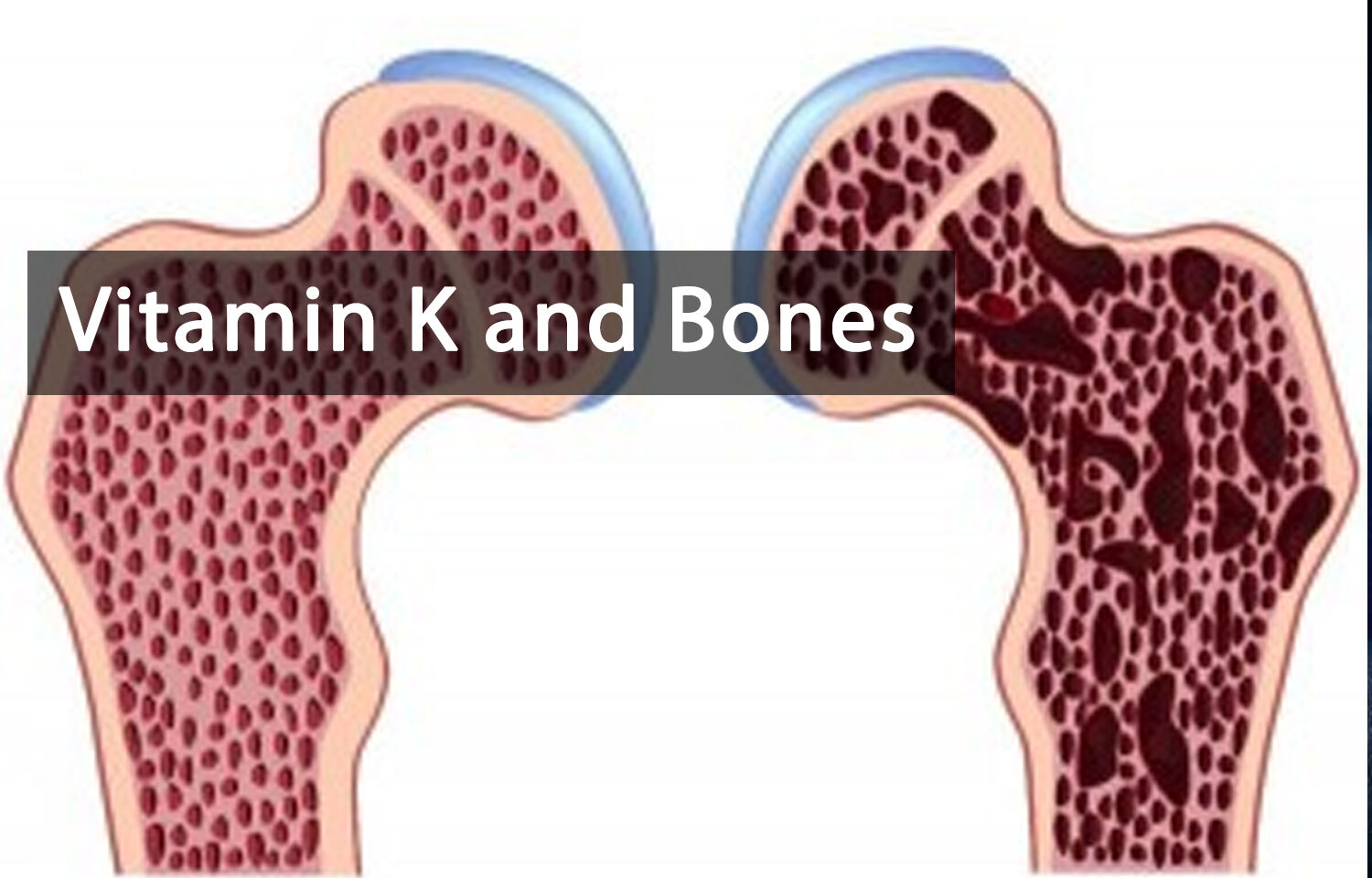 Role of Vitamin K Supplement in Increasing Bone Mineral Density in ...