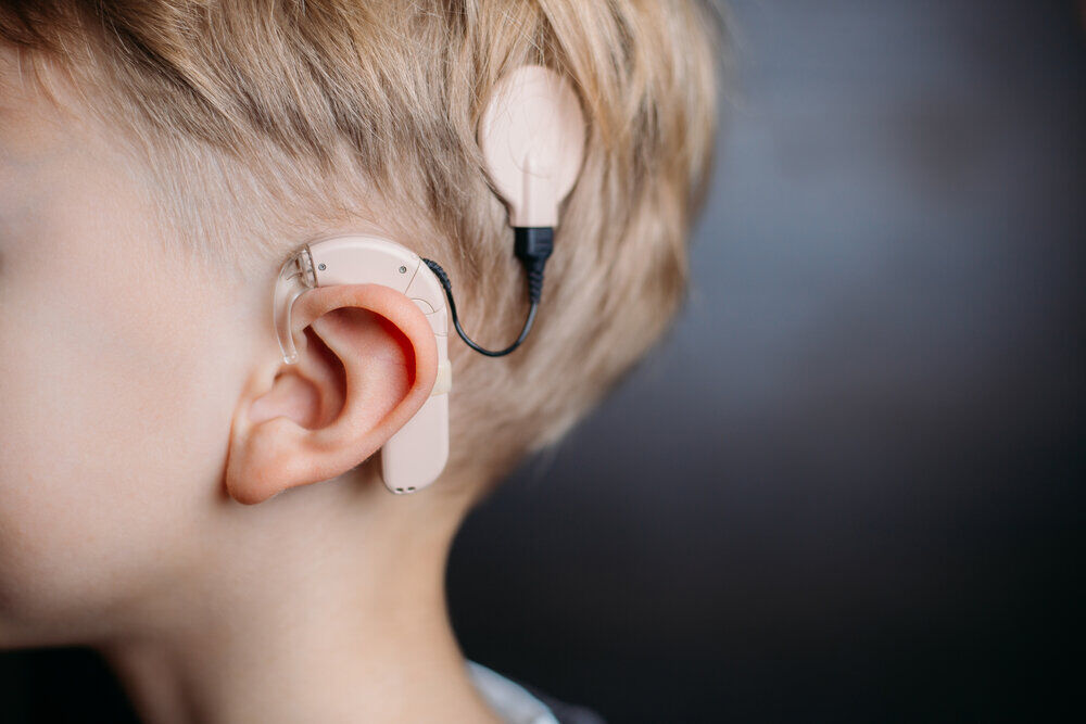 Cochlear implant for single-sided deafness improves tinnitus and vertigo