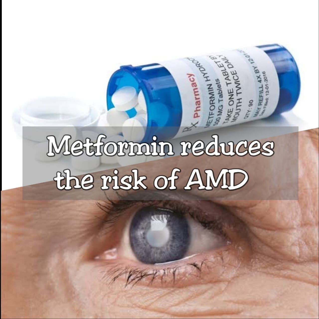 Low Dose of Metformin May Prevent Development of AMD: JAMA Study
