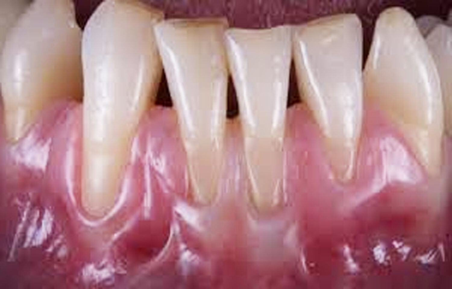 CAF, tunnelling procedures with CTG effective surgical option for ...