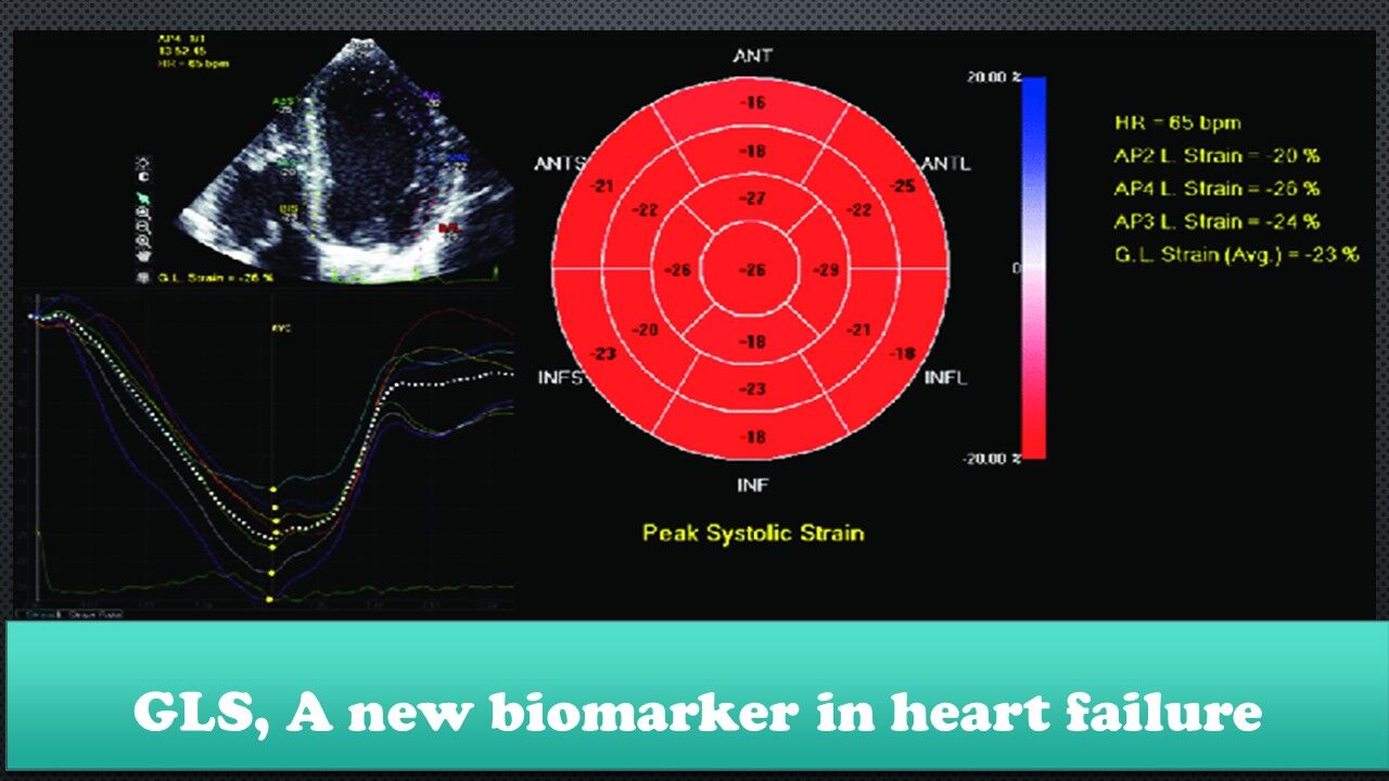 GLS improves risk stratification in heart failure patients, MyoVasc study