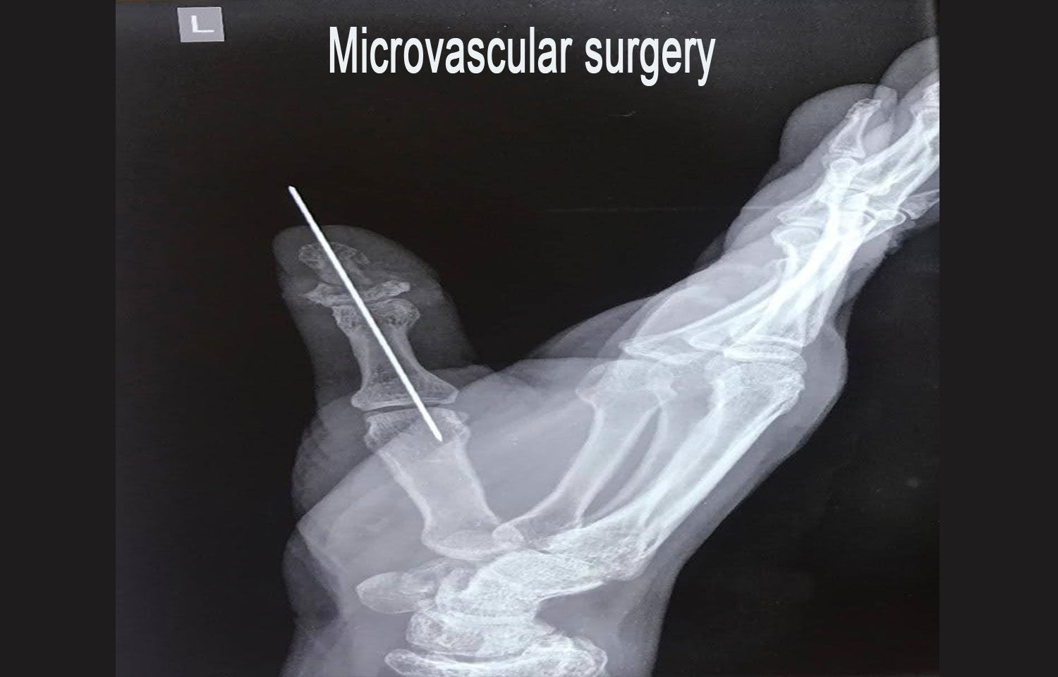 Doctors perform successful reconstructive surgery after man Loses Half ...