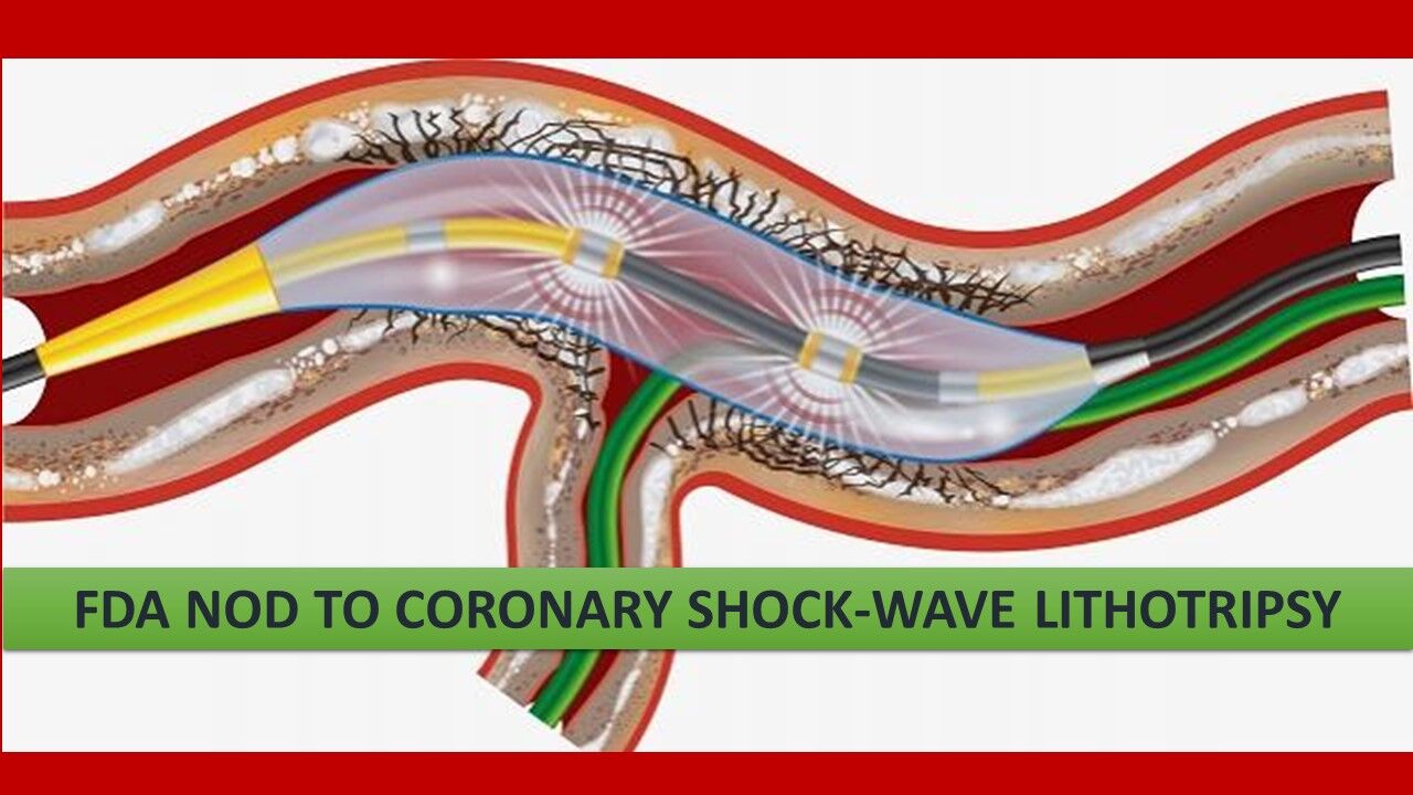 Shock-wave lithotripsy gets FDA approval