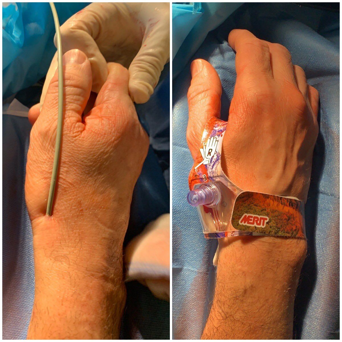 Distal Radial Access, a Promising Approach for Minimally Invasive ...
