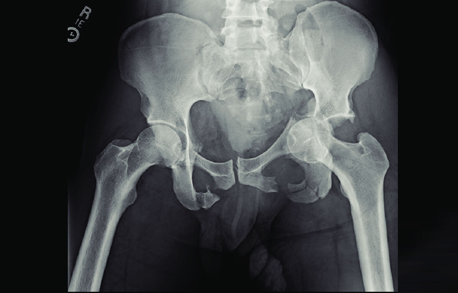 Pelvic bone loss may contribute to pelvic stress fracture after hip ...