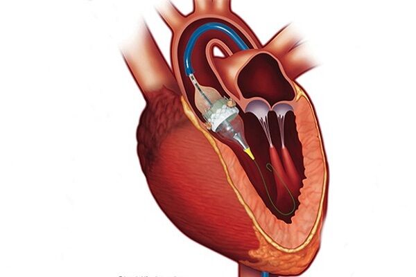 BASILICA safe and successful procedure with low rate of coronary ...