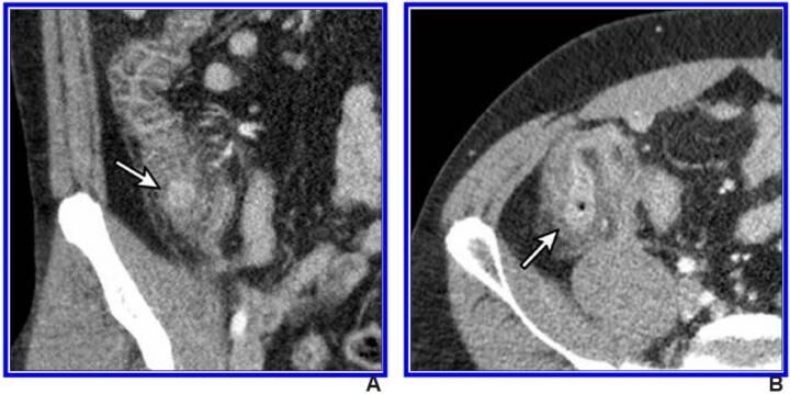 Low-dose CT for right colonic diverticulitis an alternate diagnosis of ...