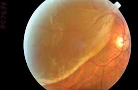 "Malignant hypertension unveiling as Bilateral exudative retinal ...