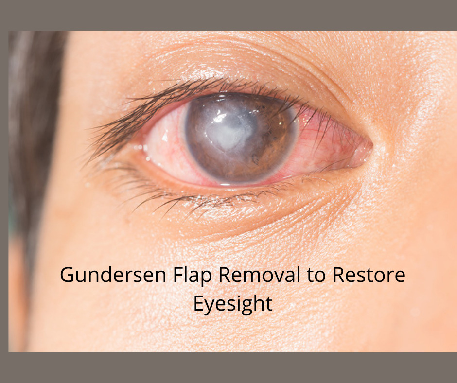 "Gundersen Flap Removal to Restore Eyesight Without Limbal ...