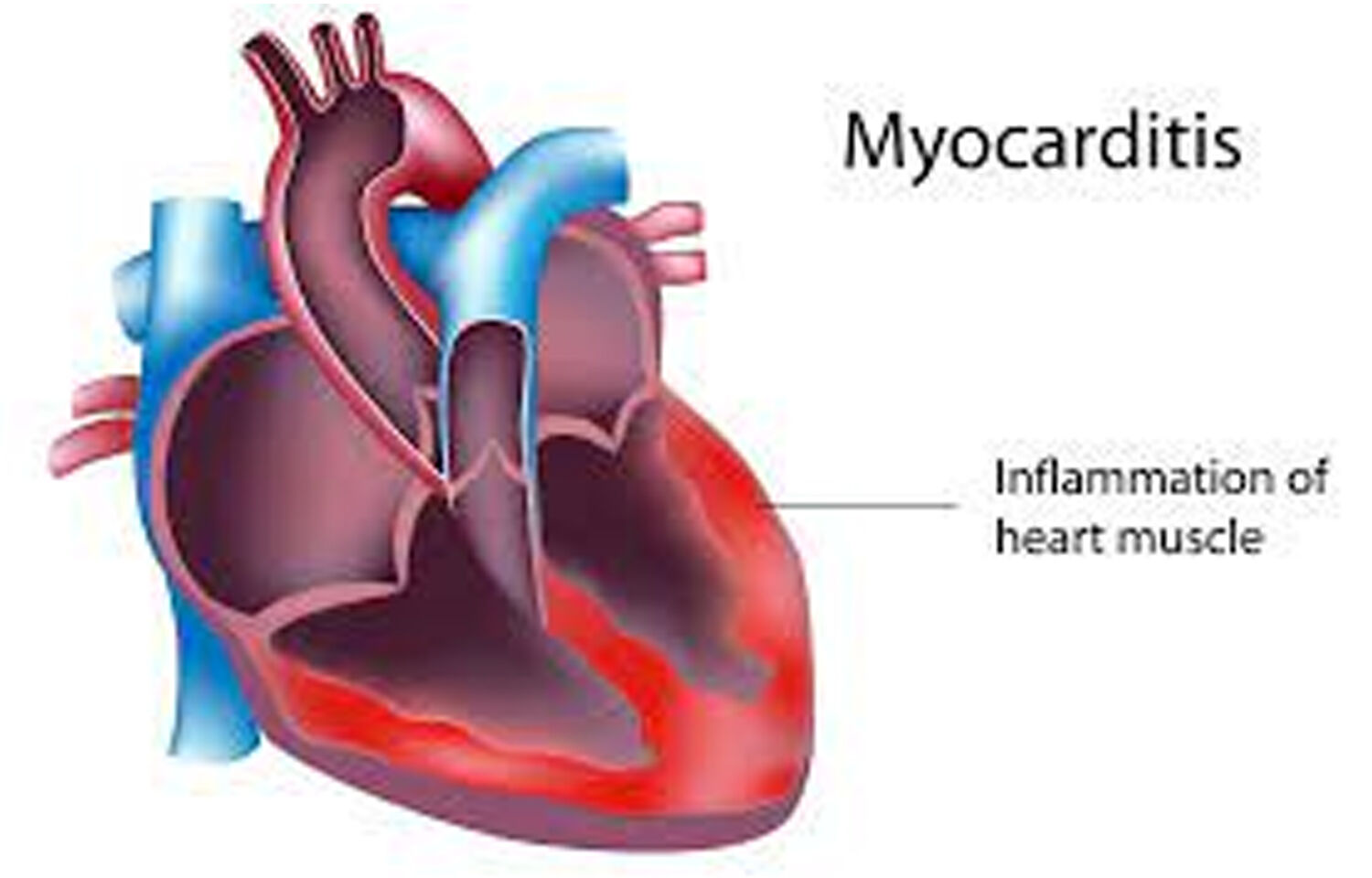 New Diagnostic Criteria and 4-Stage Classification for Myocarditis: Key ...