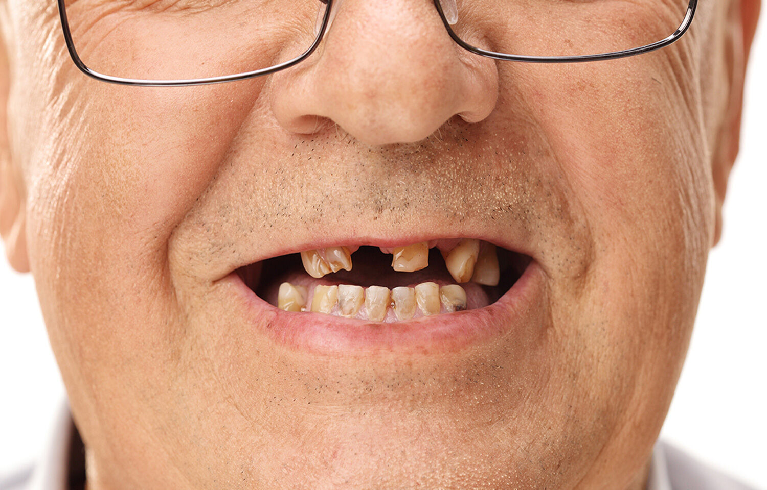 Tooth loss linked to increased risk of dementia, cognitive decline in ...