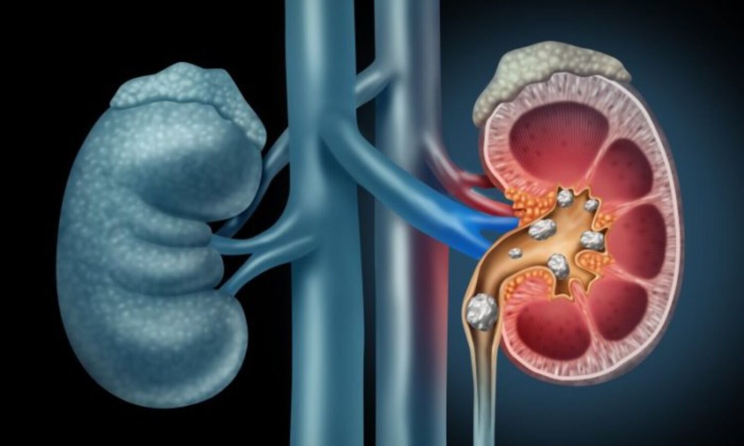 Ceftriaxone Linked to Urinary Tract Stones in Children, finds meta analysis
