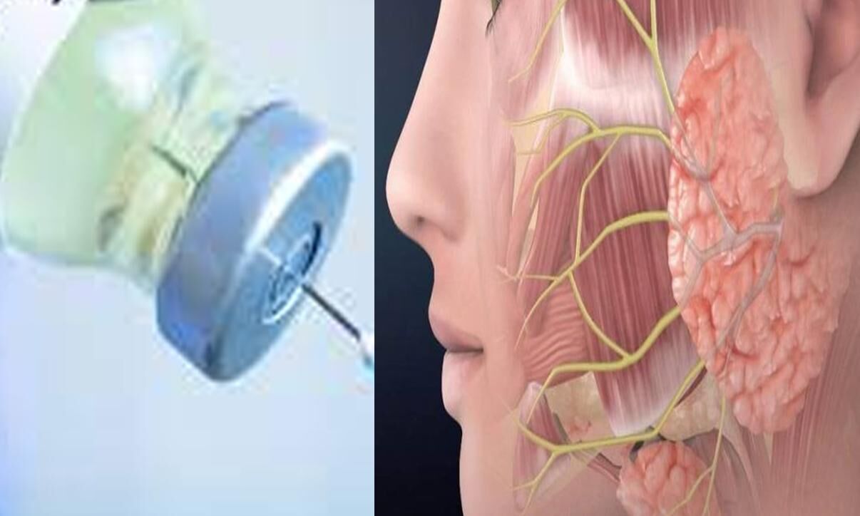 Parotid- mastoid fascia helps identify facial nerve trunk during ...