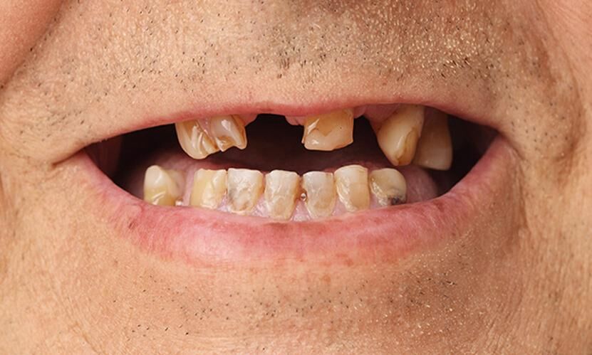 Direct resin composite good treatment option for severe, generalized ...