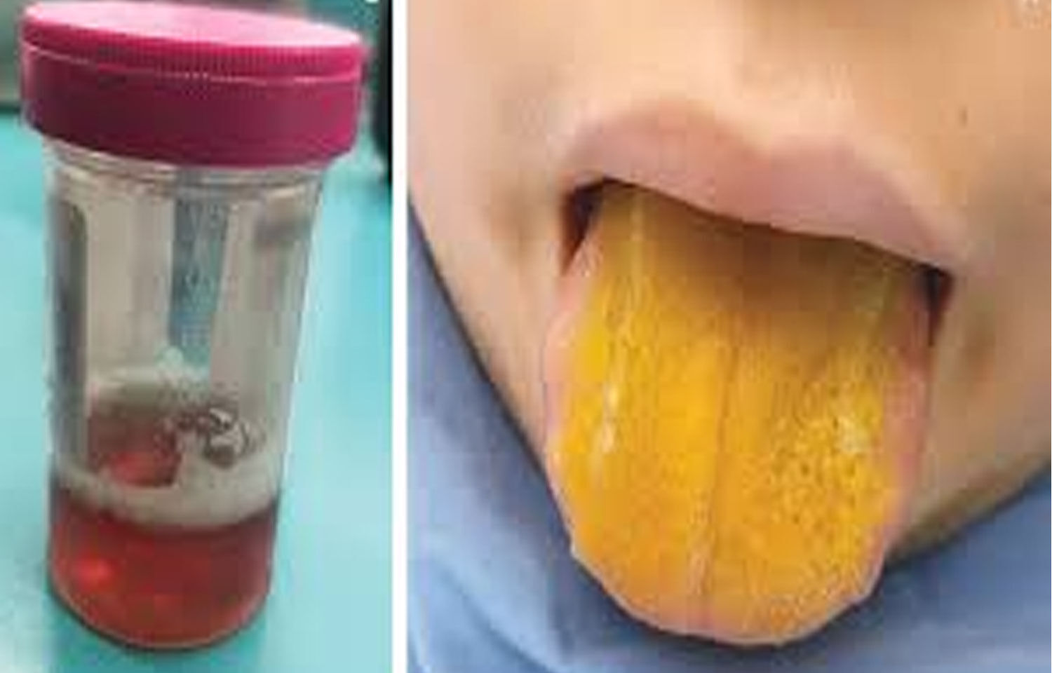 Boy with icteric tongue diagnosed with Epstein-Barr virus: Case Report