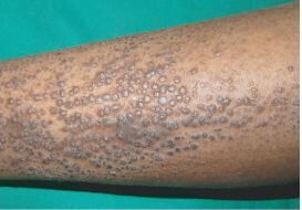 Dermoscopy of primary cutaneous amyloidosis: A retrospective analysis