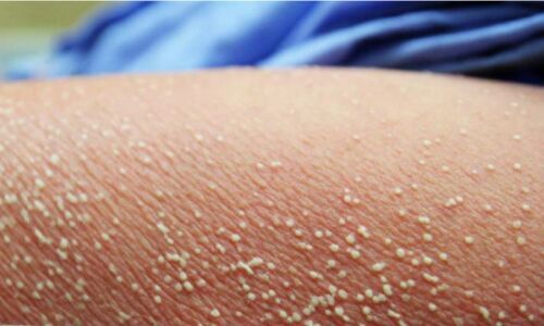 Favipravir induced Acute generalized exanthematous pustulosis: 1st case ...