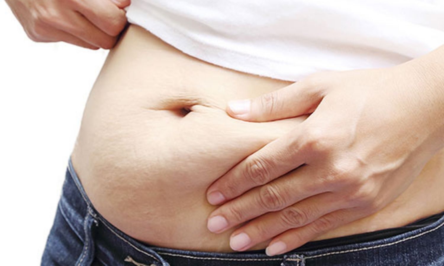 Management of rectus diastasis: EHS guideline