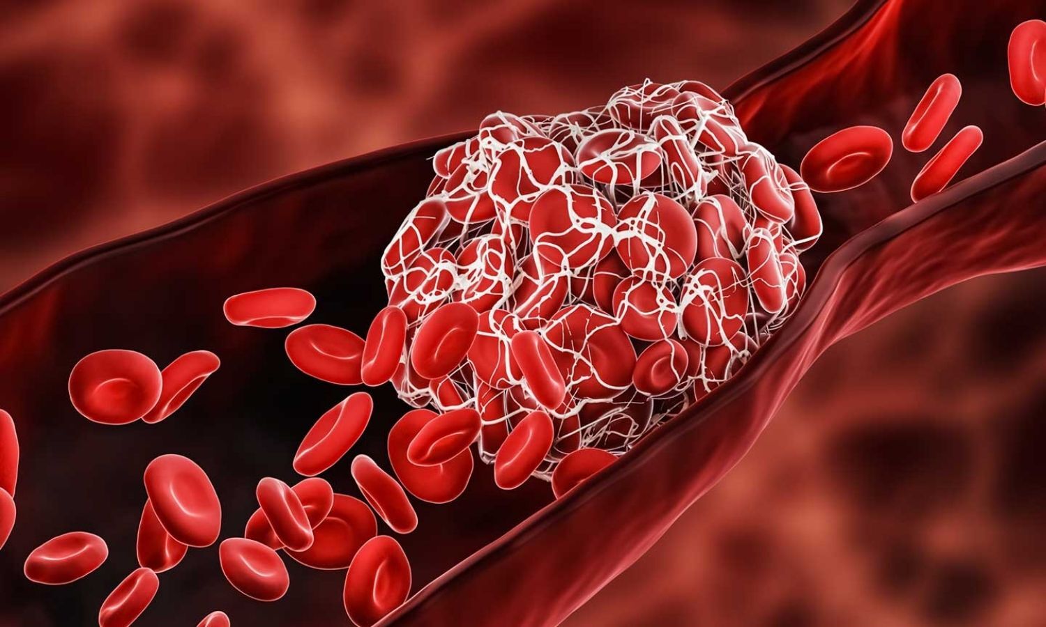 Thrombocytopenia Linked to Worse Outcomes in Pneumonia, COPD, and ...