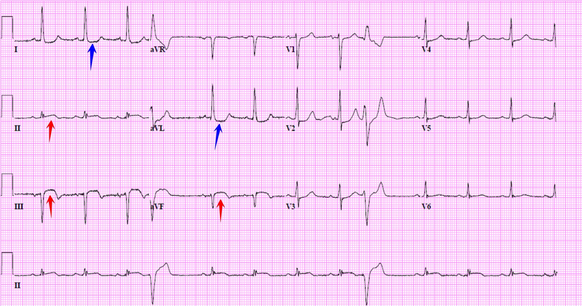 Surgical repair of postinfarction VSR tied to high early mortality risk ...