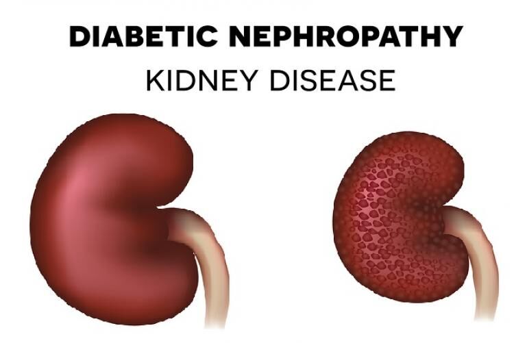 Diabetic Nephropathy Images
