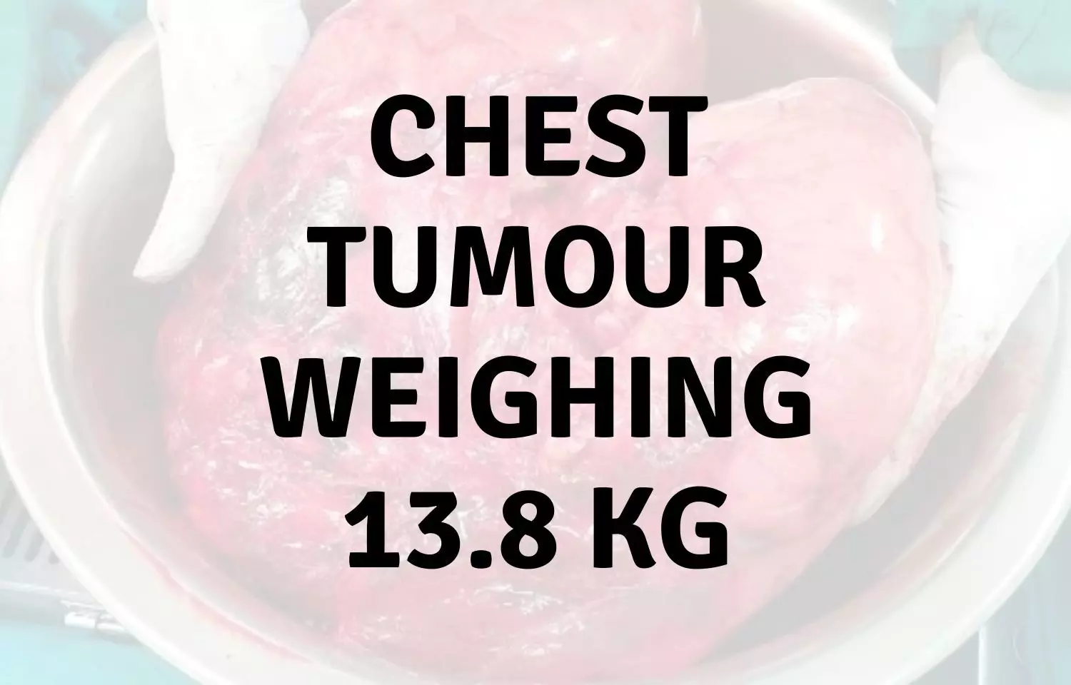 World's largest Chest tumor weighing 13.8 kg removed by Fortis Gurugram ...