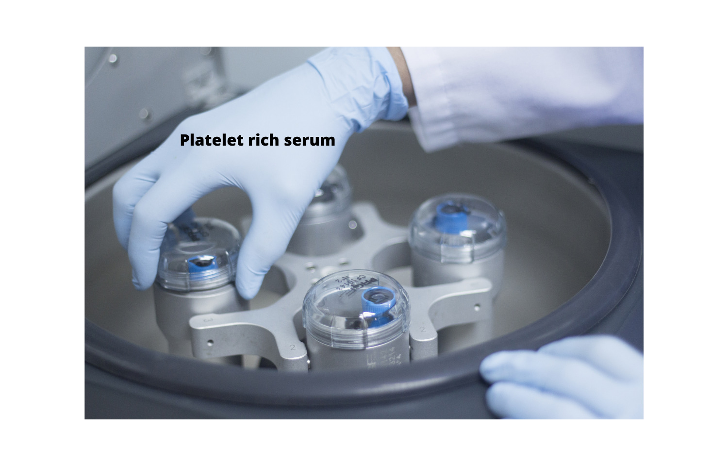 Platelet rich plasma may improve recovery in Pilonial Sinus patients