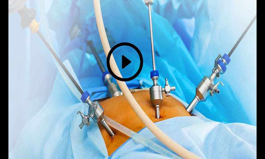 Laparoscopy superior to laparotomy for managing ruptured tubal ectopic ...