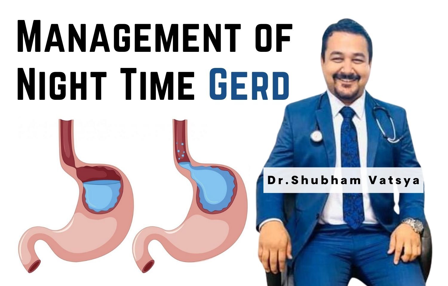 Managing Night Time GERD: Comparative Review of Efficacy of ...